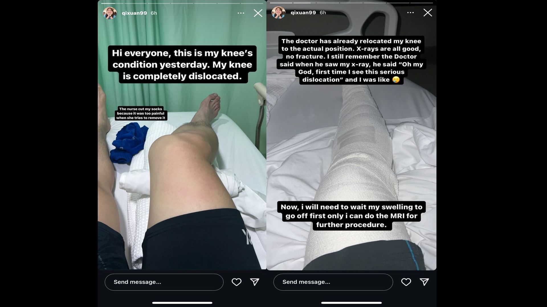 Pemain badminton negara kongsi gambar keadaan lutut yang terkehel ... Pemain badminton negara kongsi gambar keadaan lutut yang terkehel ...
