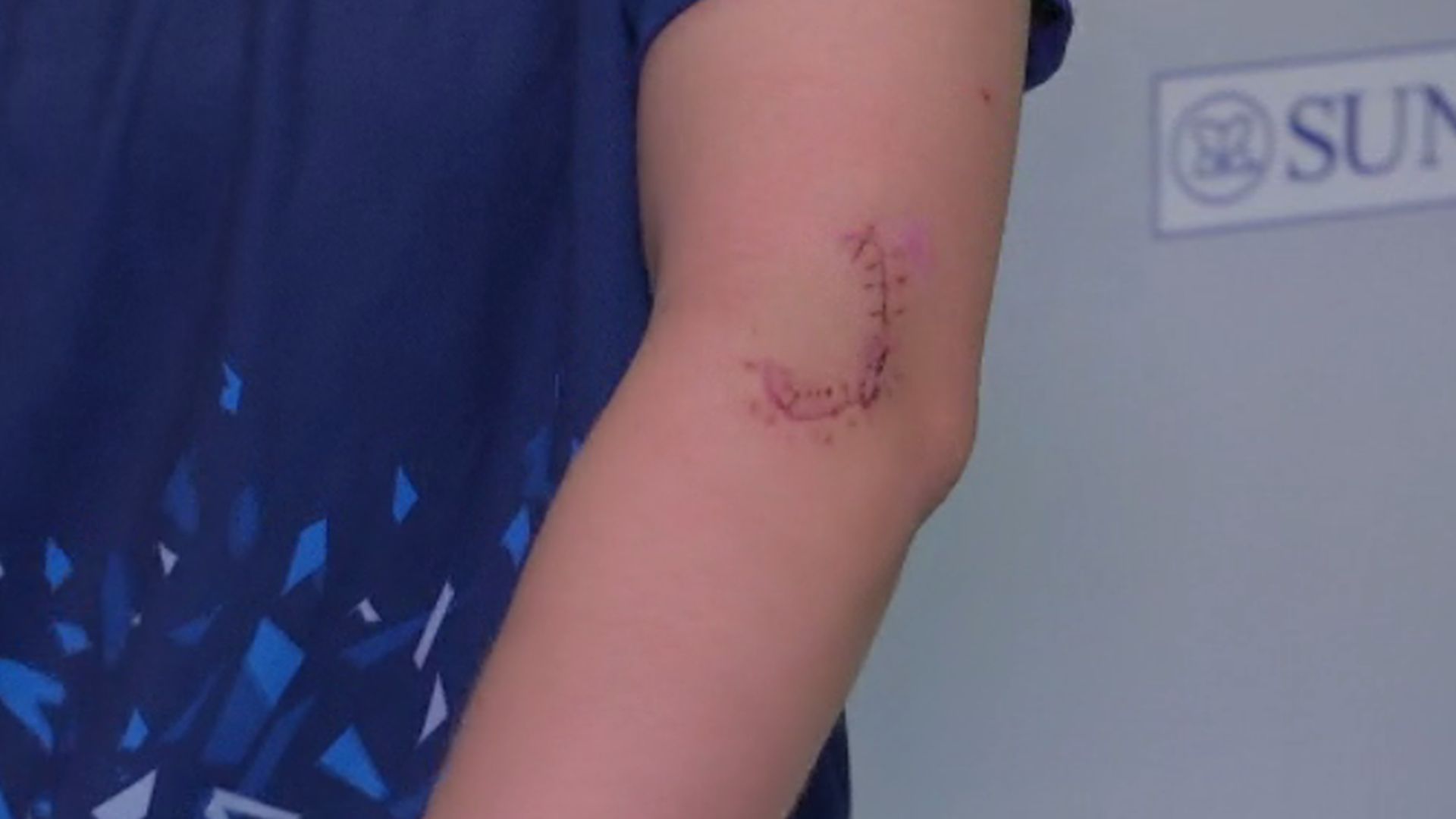 Ini kesan 16 jahitan di lengan Toh Ee Wei | Stadium Astro - English